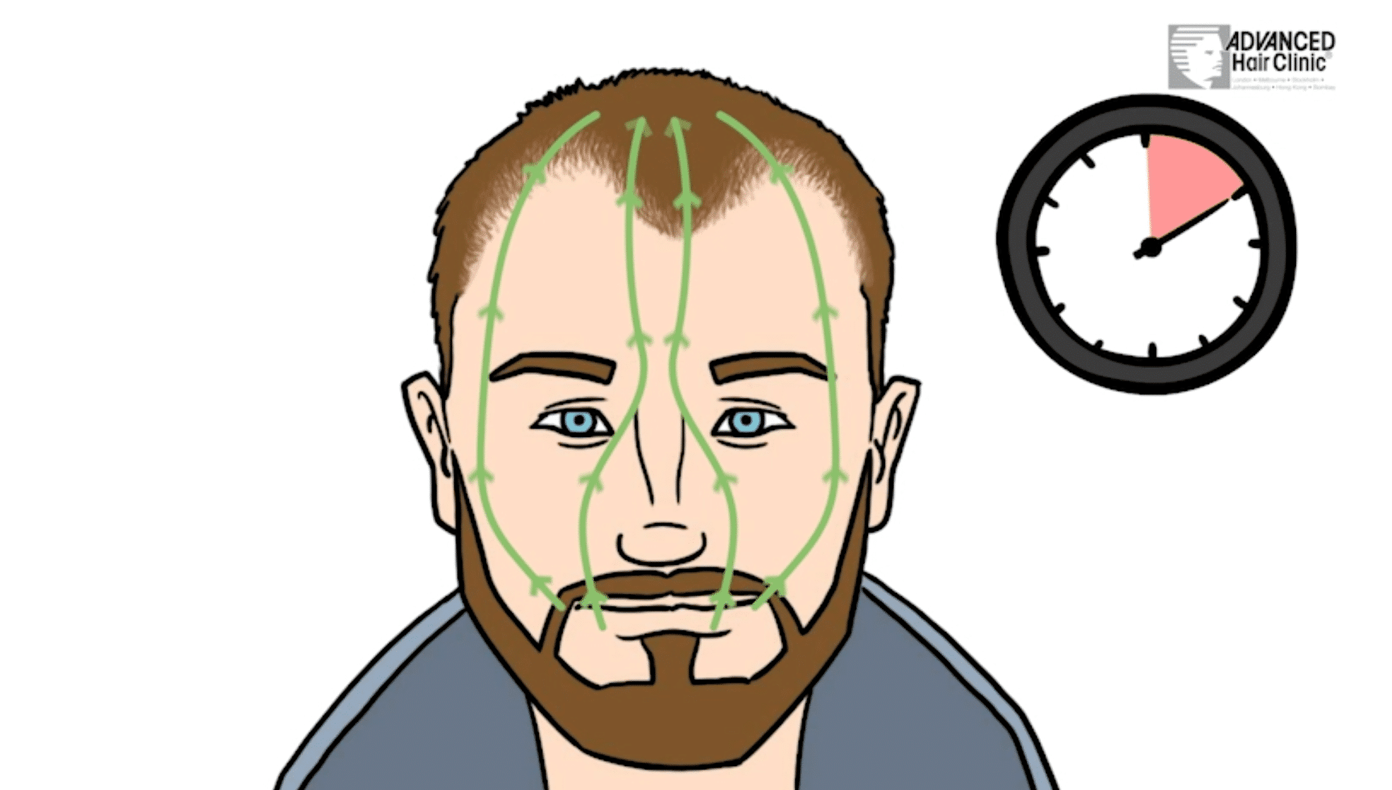 Male Hair Loss & Treatment | Advanced Hair Studio